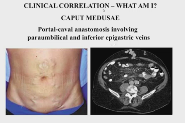 EXAMS AND ME : Caput Medusae