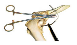 Duda's Epic Quest To Epicness: Needle Drivers.