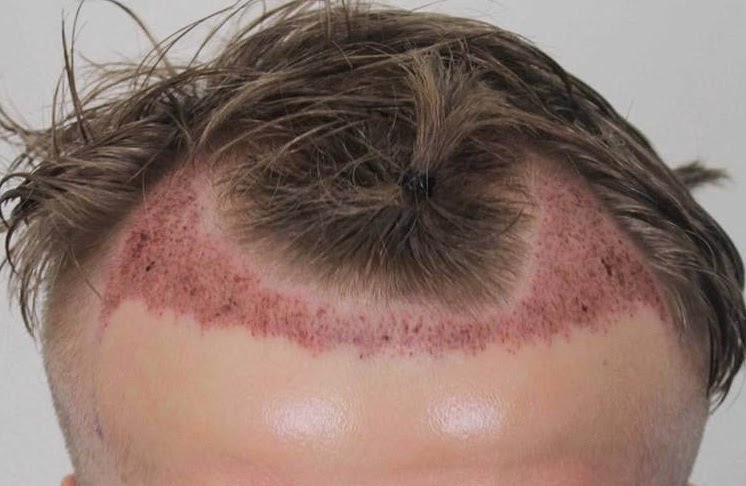 hair solutions: Dr. H. Rahal - 1201 Grafts - Class: 2 - FUE - Male