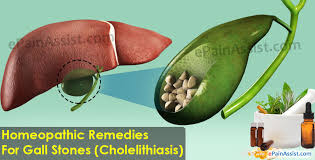 Homeopathic and Ayurvedic medicines: HOMOEOPATHIC MEDICINES FOR GALL STONES