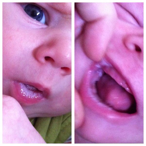 Seuchenalarm! Jannes hat Soor - Kugelfisch-Blog - Der Familienblog aus ...