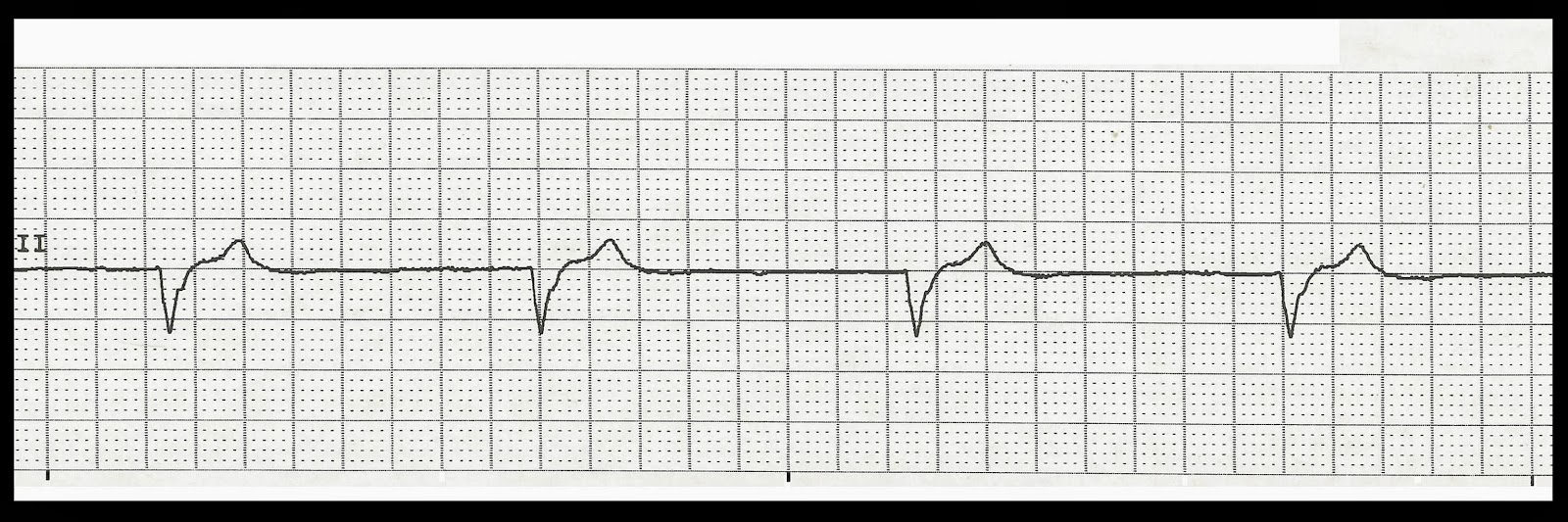 Practice EKG Rhythm Strips 231