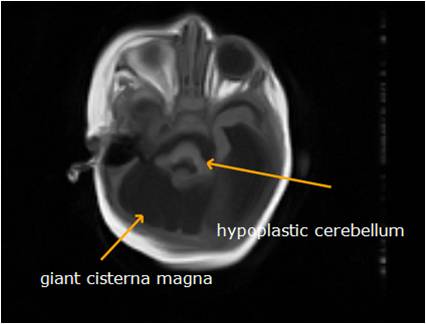 Dandy Walker Malformation-MRI - Sumer's Radiology Blog