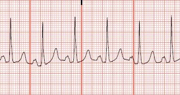 EKG Rhythm Strips: Hyperkalemia part 2