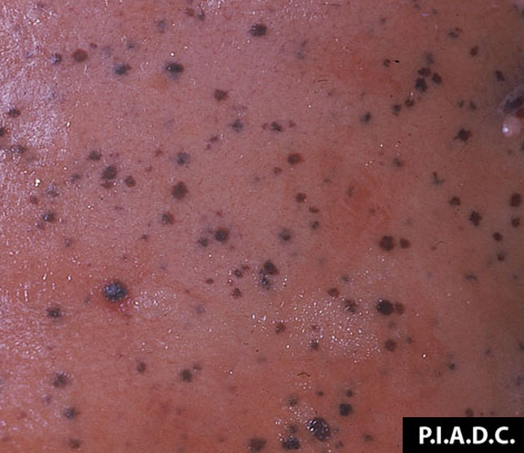 Glosario De Enfermedades Infecciosas