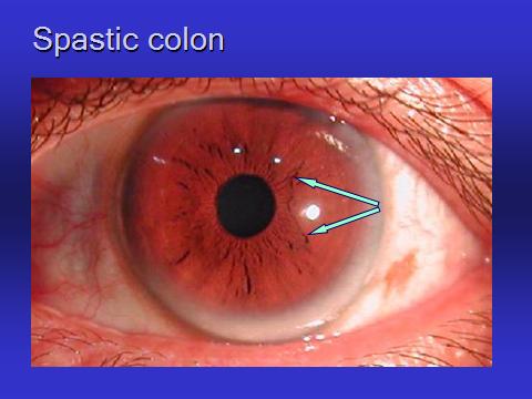 PERSATUAN PENGAMAL IRIDOLOGY MALAYSIA: Apa itu Spastic Colon
