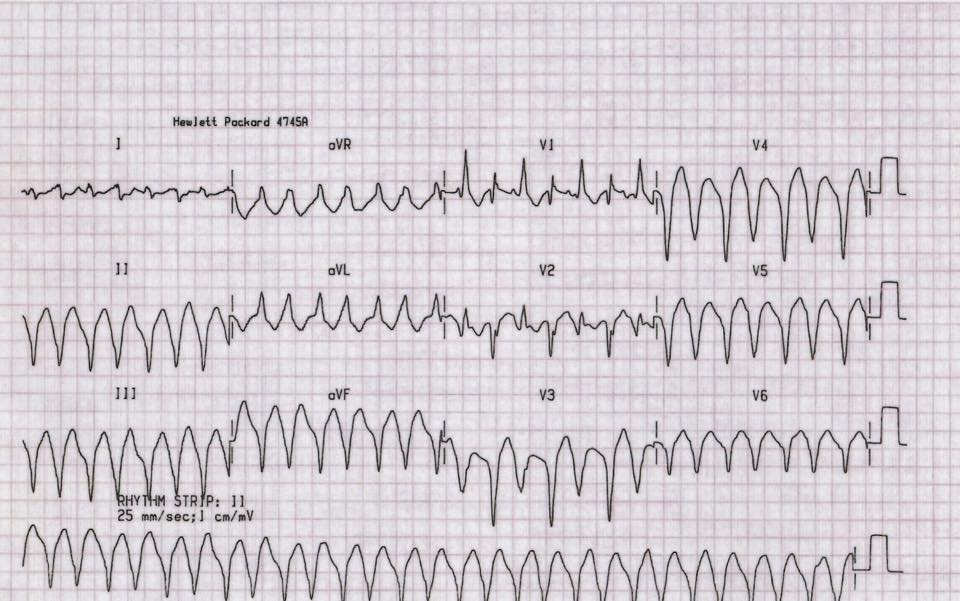 Clinical Electrocardiology ECG Blog