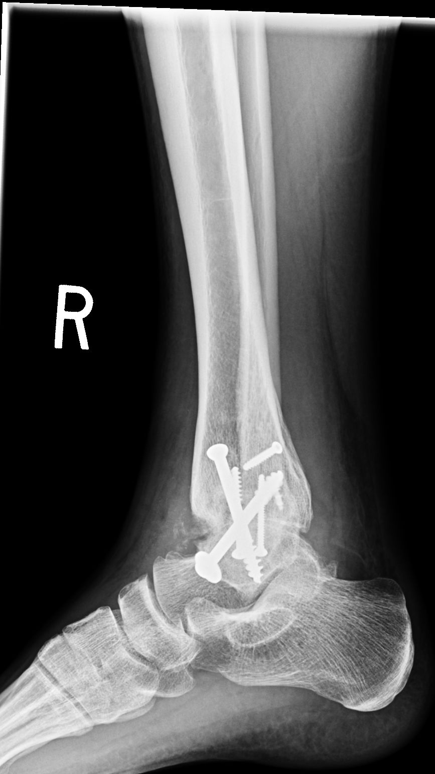 Two Broken Ankles: Images from Post-Op