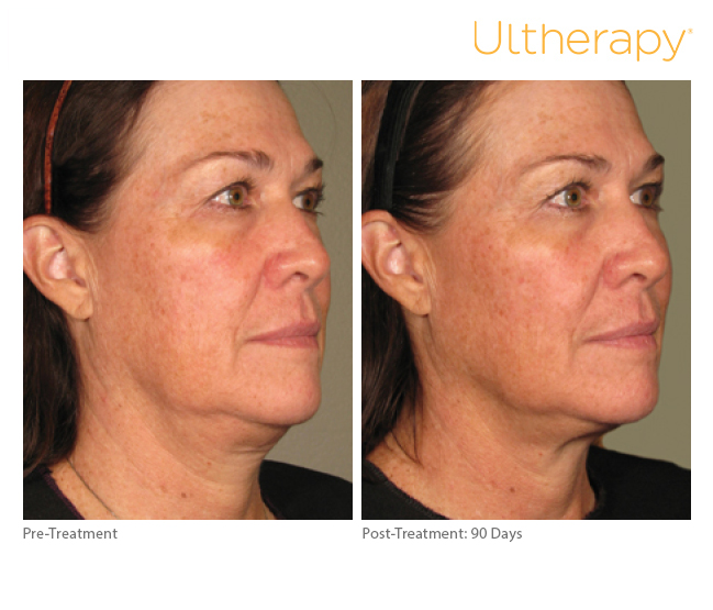 What Is Ultherapy? ~ Beauty Tip Of The Week #18 - Corinna B's World