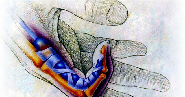 Assessing Injection Techniques in the Treatment of Trigger Finger