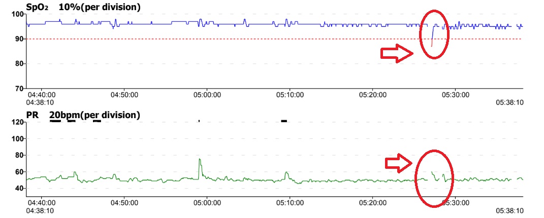Sleep apnea : SPO2 @ 12000 feet elevation