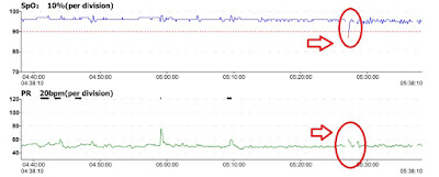Sleep apnea : SPO2 @ 12000 feet elevation