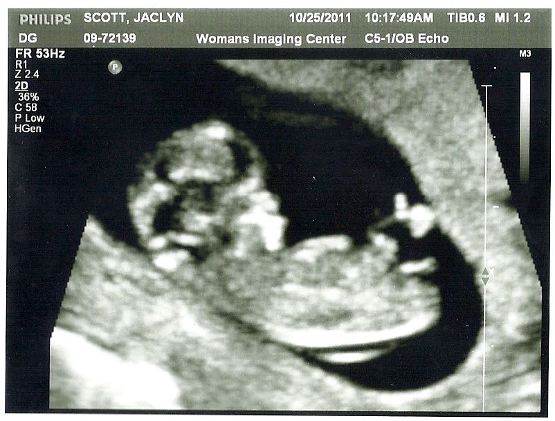 Our Scott Spot: 11 Week Ultrasound