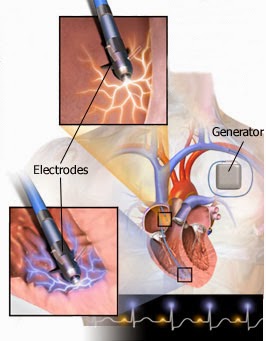 Temporary Pacemakers | Kalangkang Mencrang