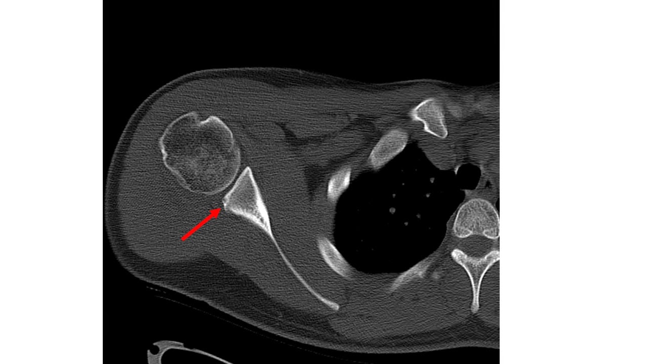 Shoulder and Elbow Surgery: Reverse Bankart lesions and shoulder ...