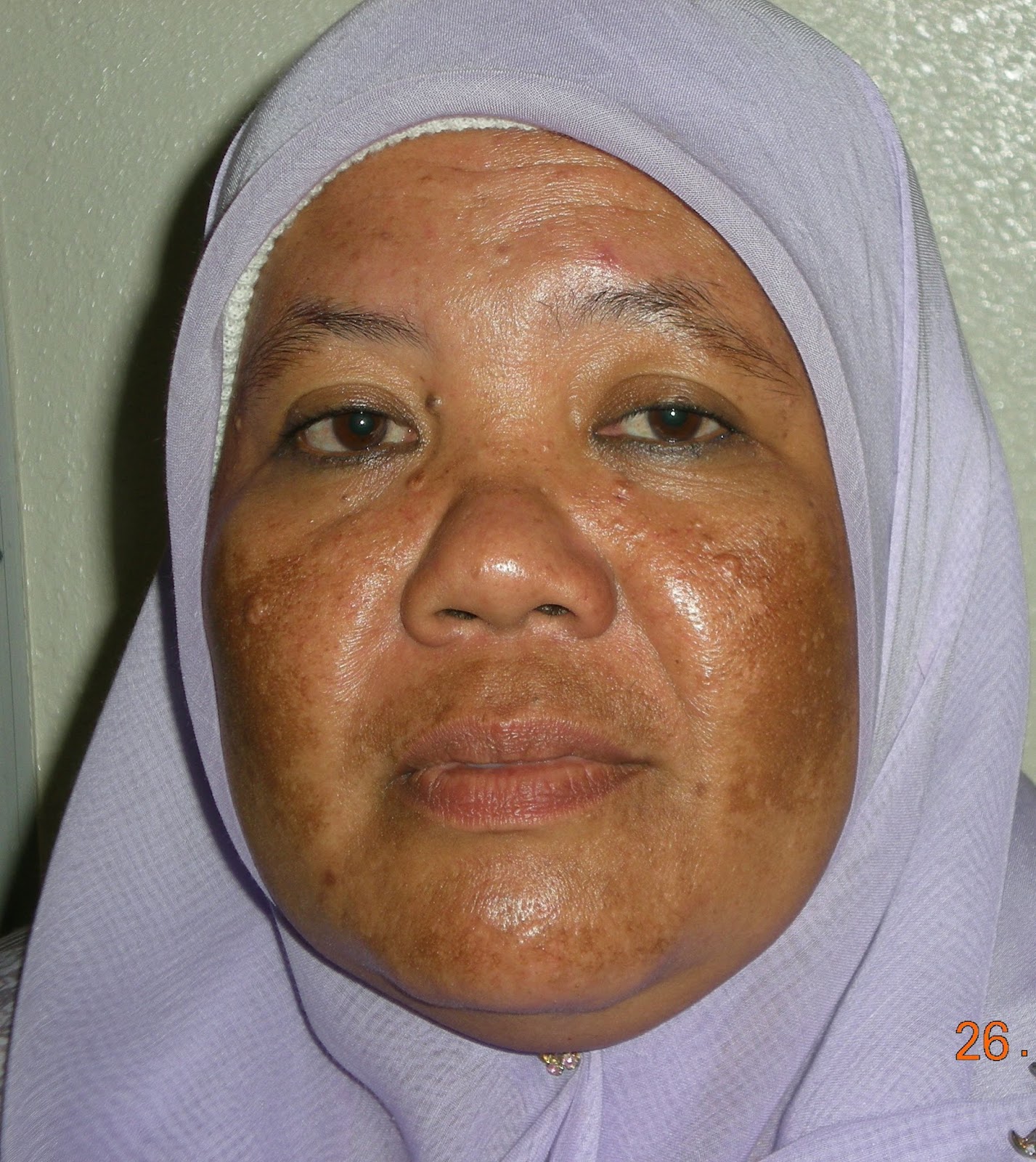 CARA HILANGKAN JERAGAT DENGAN BERKESAN DAN SELAMAT | Jom Tampil Sihat ...