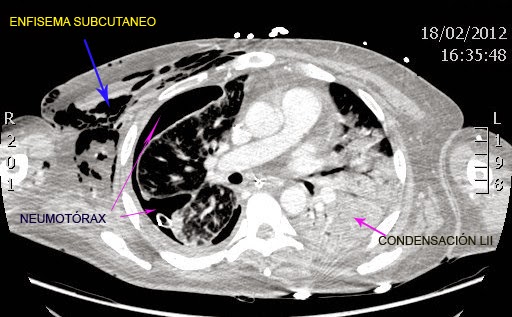 Enfisema subcutâneo