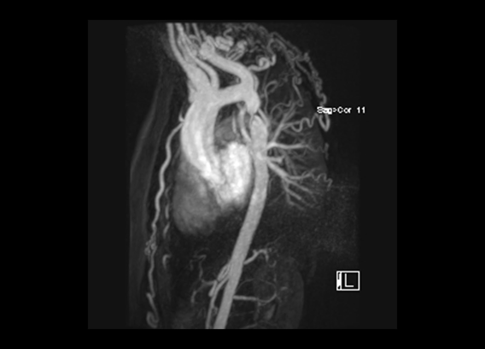 Andrew R Houghton Ten Key Facts About Coarctation Of The Aorta andrew-r-houghton-ten-key-facts-about-coarctation-of-the-aorta