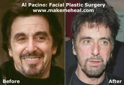 Al Pacino Plastic Surgery Before and After Botox Injections and ...
