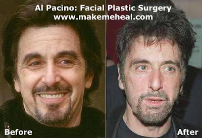 Al Pacino Plastic Surgery Before and After Botox Injections and ...
