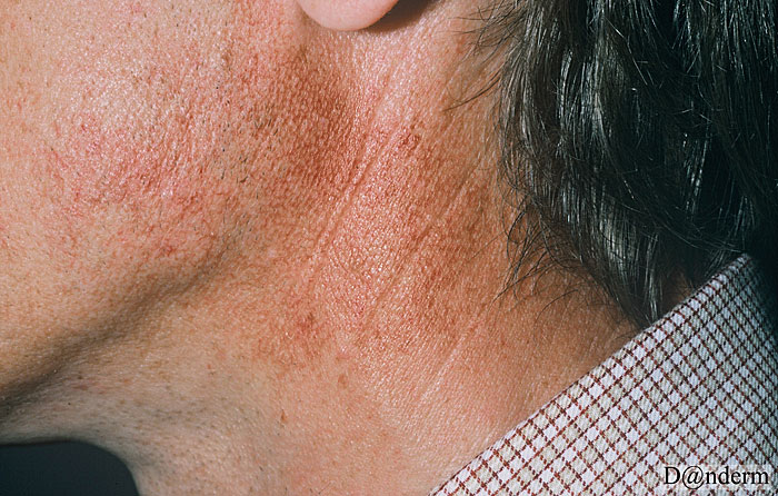 All About Laser for Hair Removal