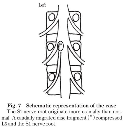 整形外科リハビリテーション学会京都支部スタッフブログ: 【文献紹介】腰椎神経根分岐の破格について