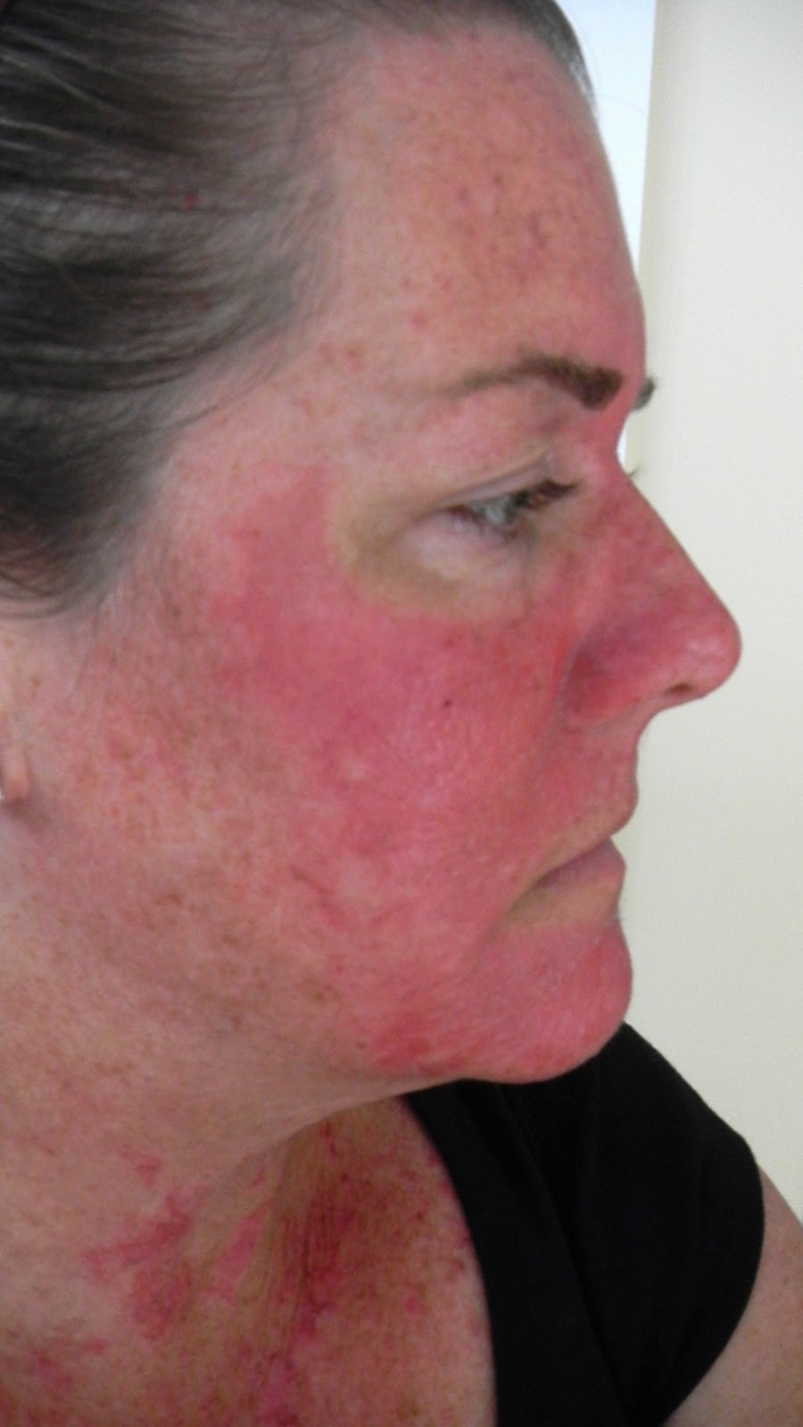 Efudex and Me 2013: Efudex Day Twenty-One