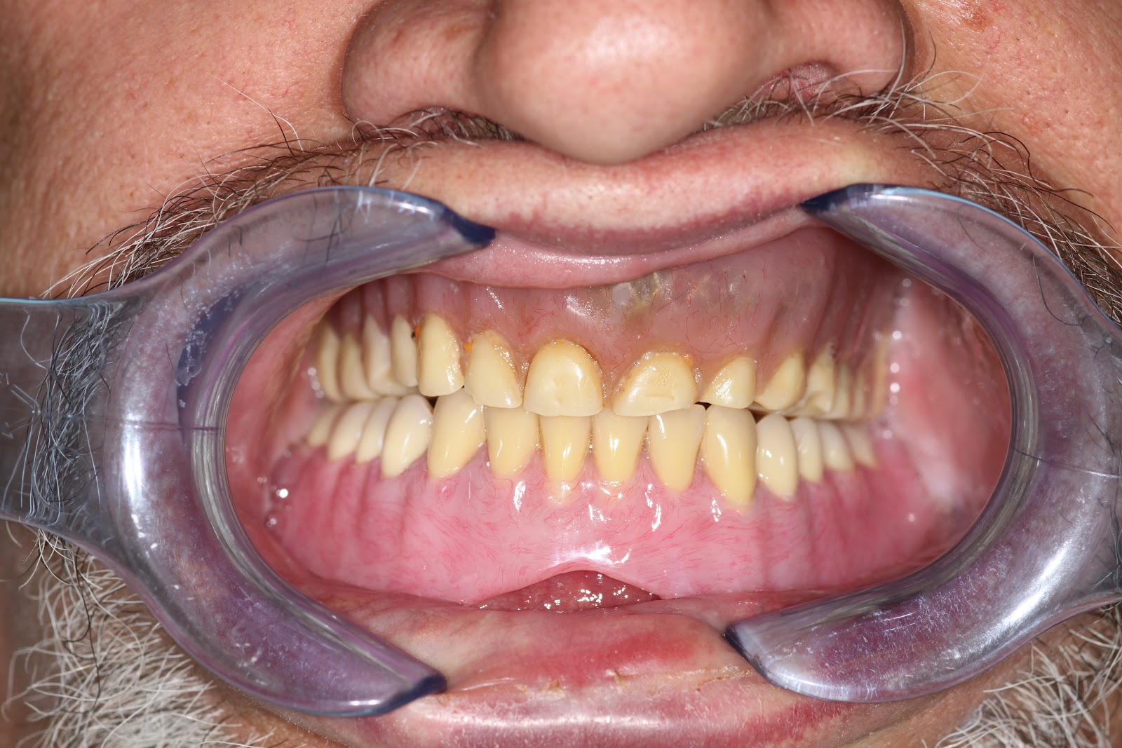 Boise Idaho Prosthodontics: Feb 6, 2012