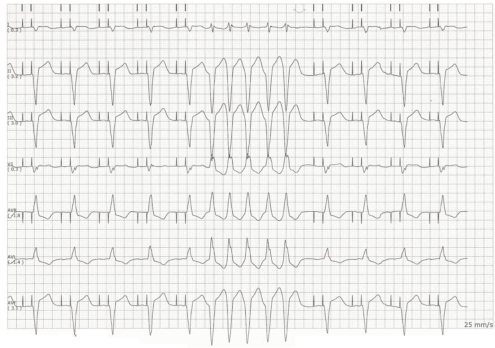 AV Paced with a Run of VT