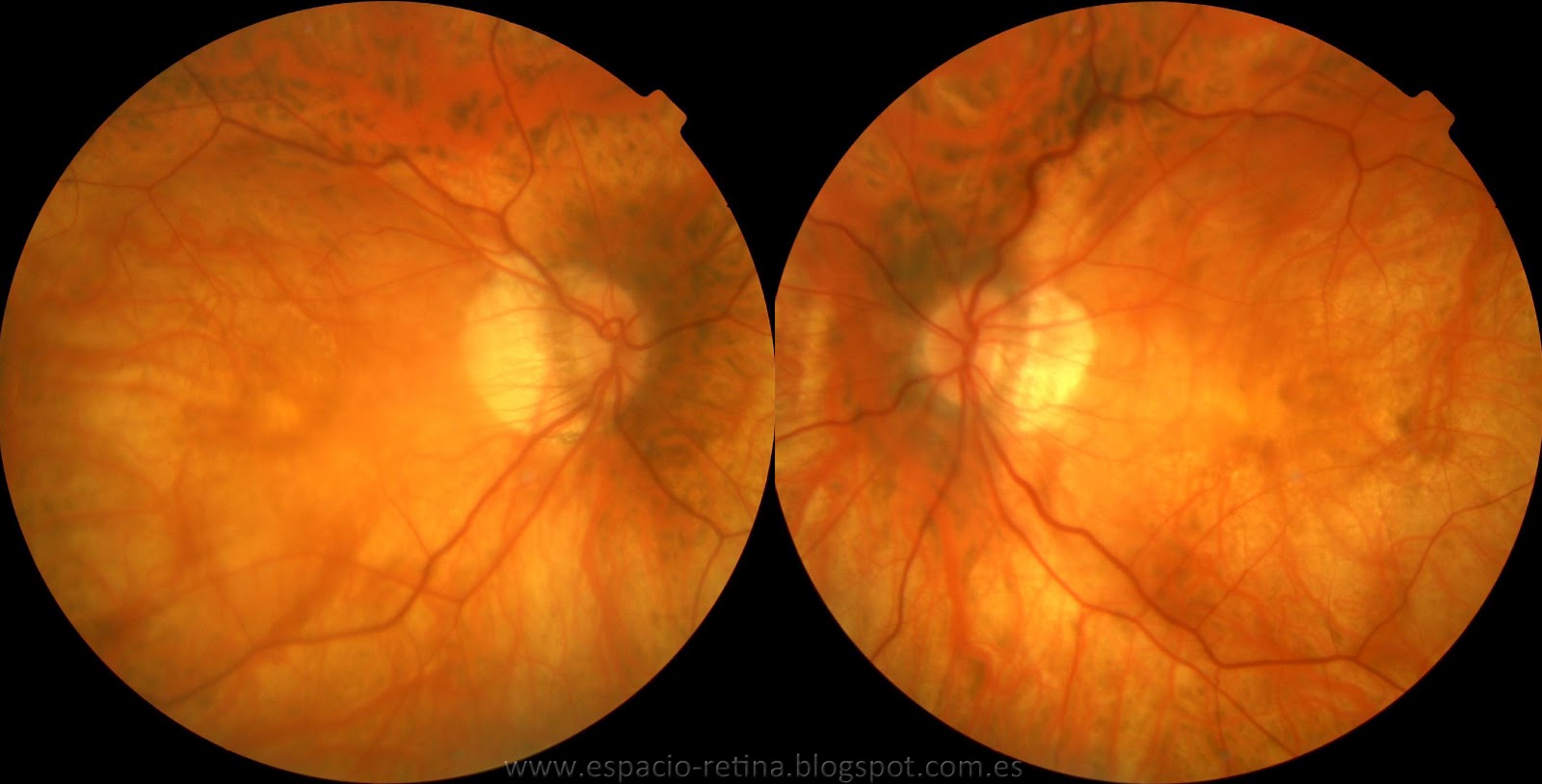 ESPACIO RETINA: Fondo miope.