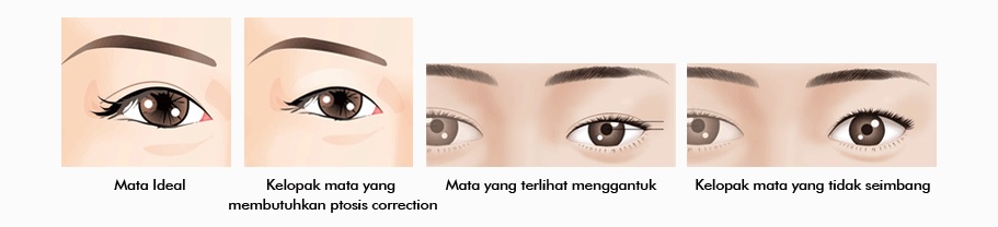 Apa itu operasi mata buka depan (magic epicanthoplasty)?