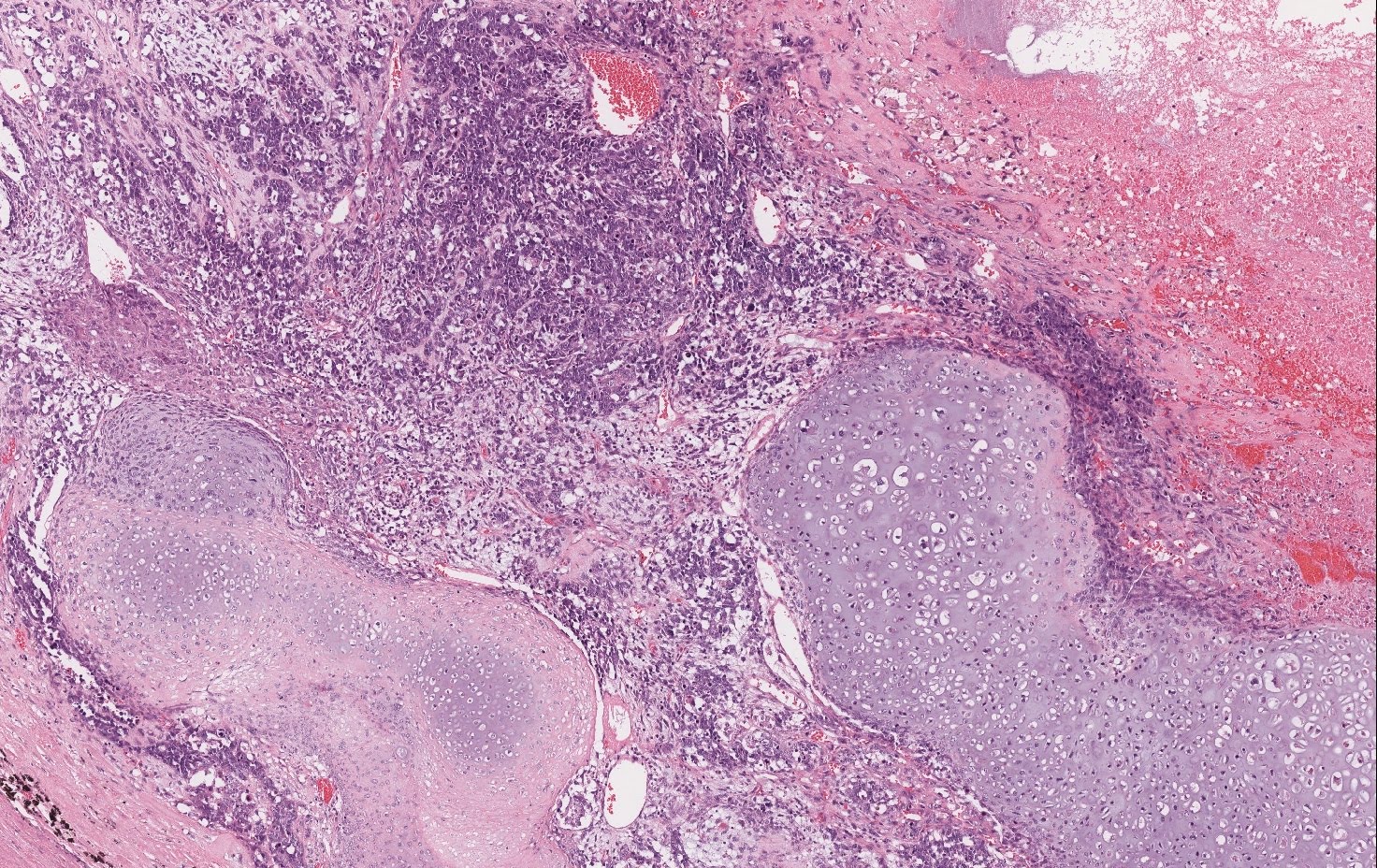GO BIG or GO HOME: Malignant teratoid medulloepithelioma