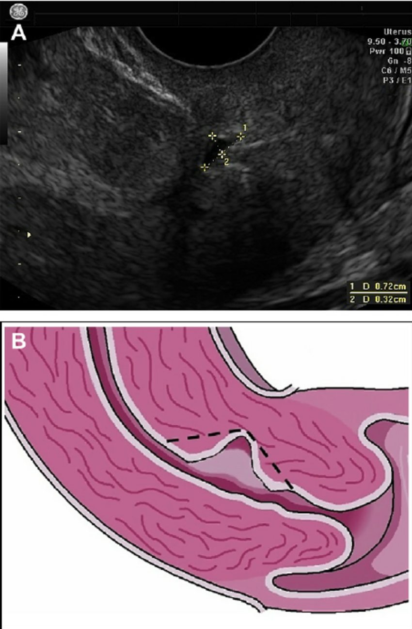 Ob/Gyn Updated : A minimal invasive approach in management of ...