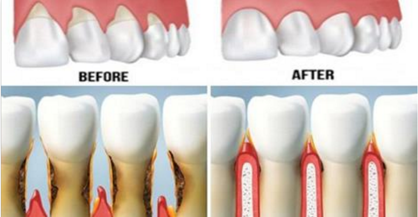 ZAUSTAVITE POVLAČENJE DESNI I STIMULIRAJTE NJIHOV RAST NA NAJBOLJI ...