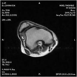 Joint Preservation and Replacement : Trochlear dysplasia in an 18 year ...