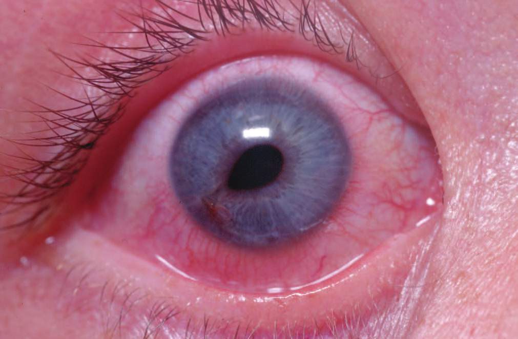 Study Medical Photos: Intraocular Foreign Body