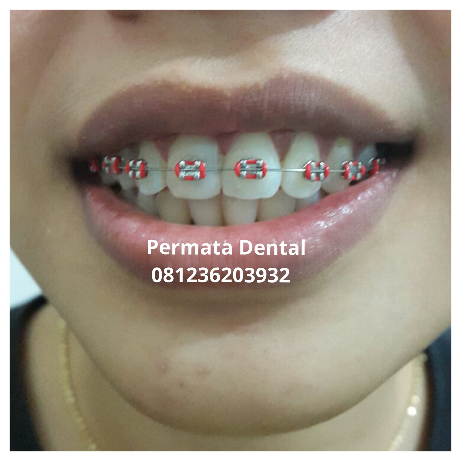 Klinik Gigi Jember Permata Dental : Behel | Bracket | Kawat Gigi Untuk ...