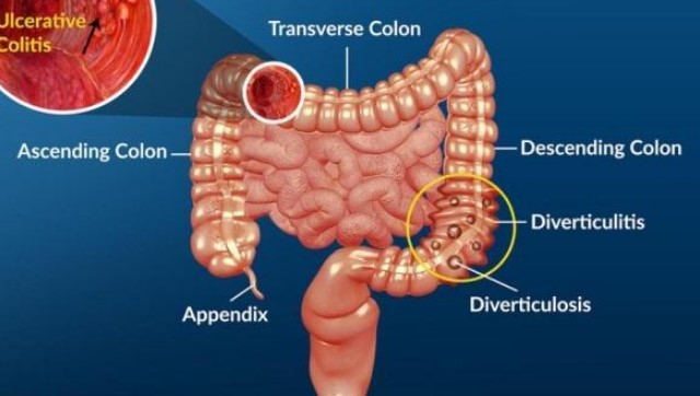 Symptoms of Colitis - Leads to and Symptoms of Colitis - A Guide