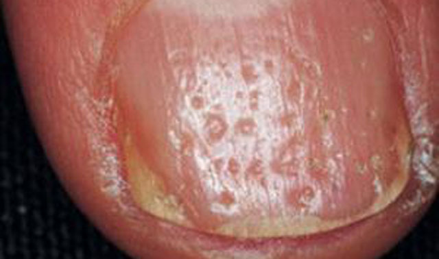 Nail pitting: Nail pitting causes
