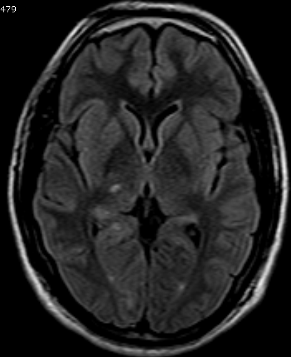 PCA Infarct-MRI - Sumer's Radiology Blog