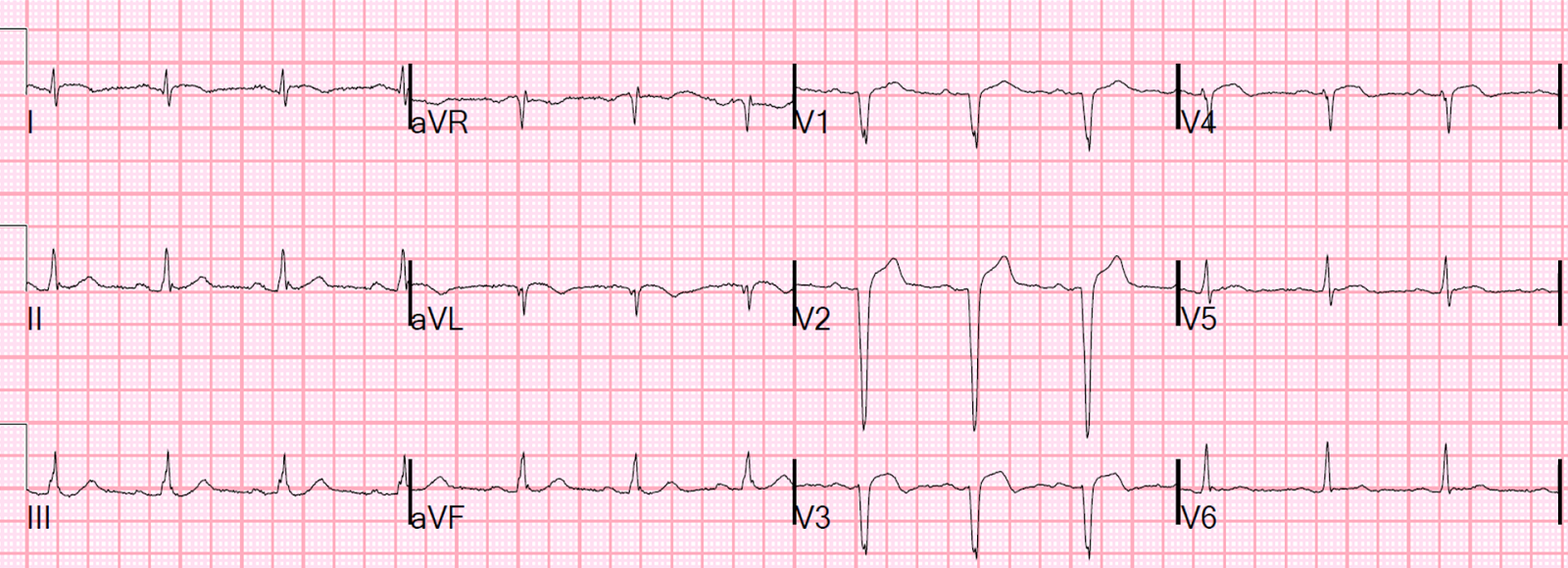 Dr. Smith's ECG Blog: Subtle Anterior STEMI Superimposed on Anterior LV ...