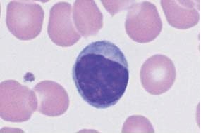 [Haematology] Abnormalities of the White Cell Series | Free Medical Atlas