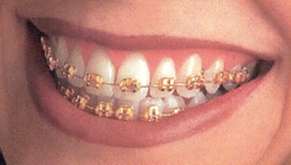Dentist Practice: What to do with buck teeth braces before and after?