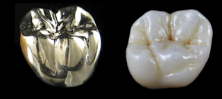 Dentistry and Medicine: PFM (Posterior) Crown Restorations ...