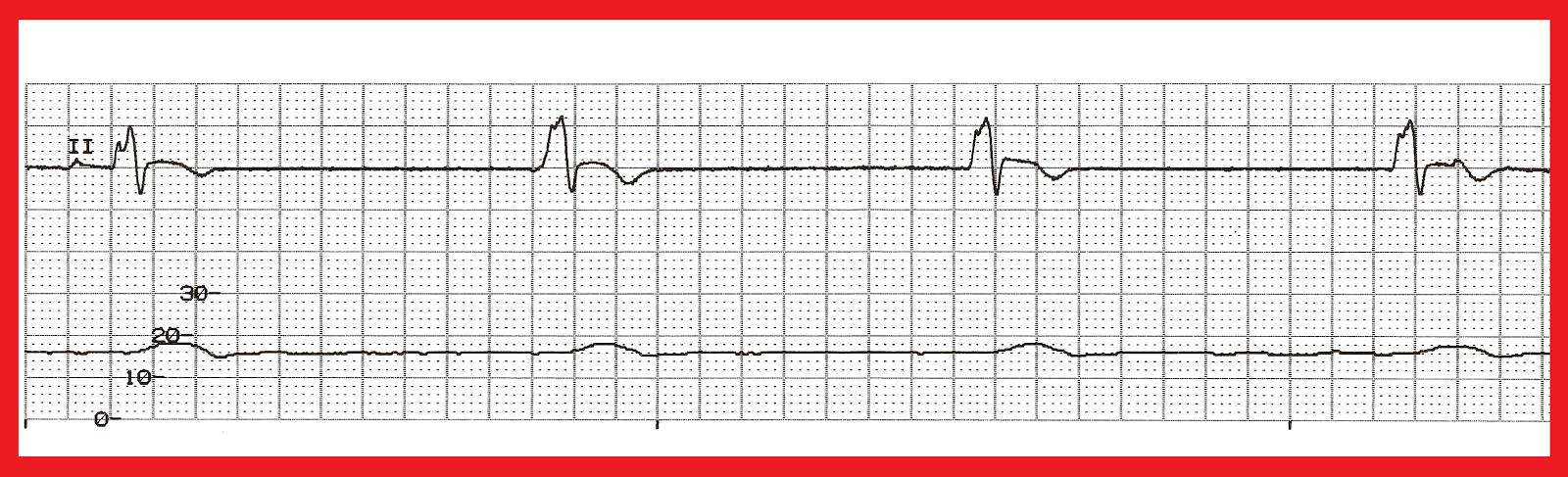 Various Idioventricular Rhythms