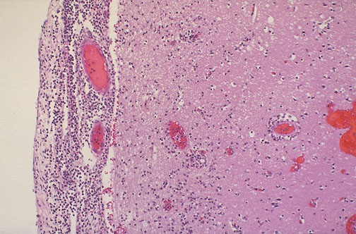 Histology and Explanation of Purulent Meningitis | MEDICAL CHOICES