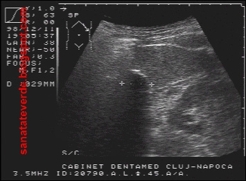 imagini splina Calcefiere splenica ecografie | Terapii naturiste si ...