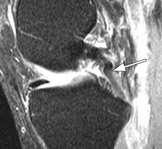 Radiology Channel: Anatomy of bundles of ACL and PCL.