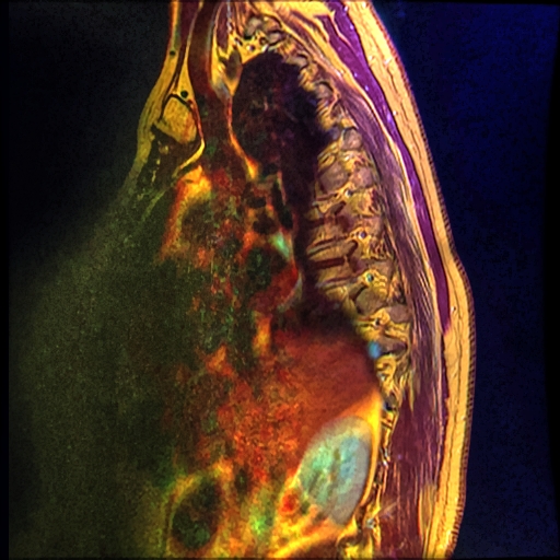 Nevit's blog: Dorsal Spine Color MRI