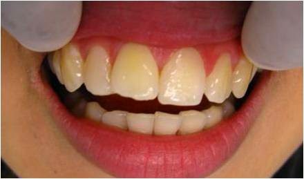 Dr Peter Miles - orthodontic mythbusters: DOES EARLY TREATMENT OF ...